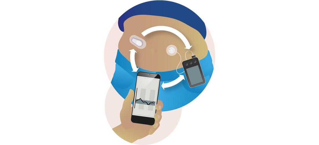 Hybrid closed loop-systemen - diabetes.nl