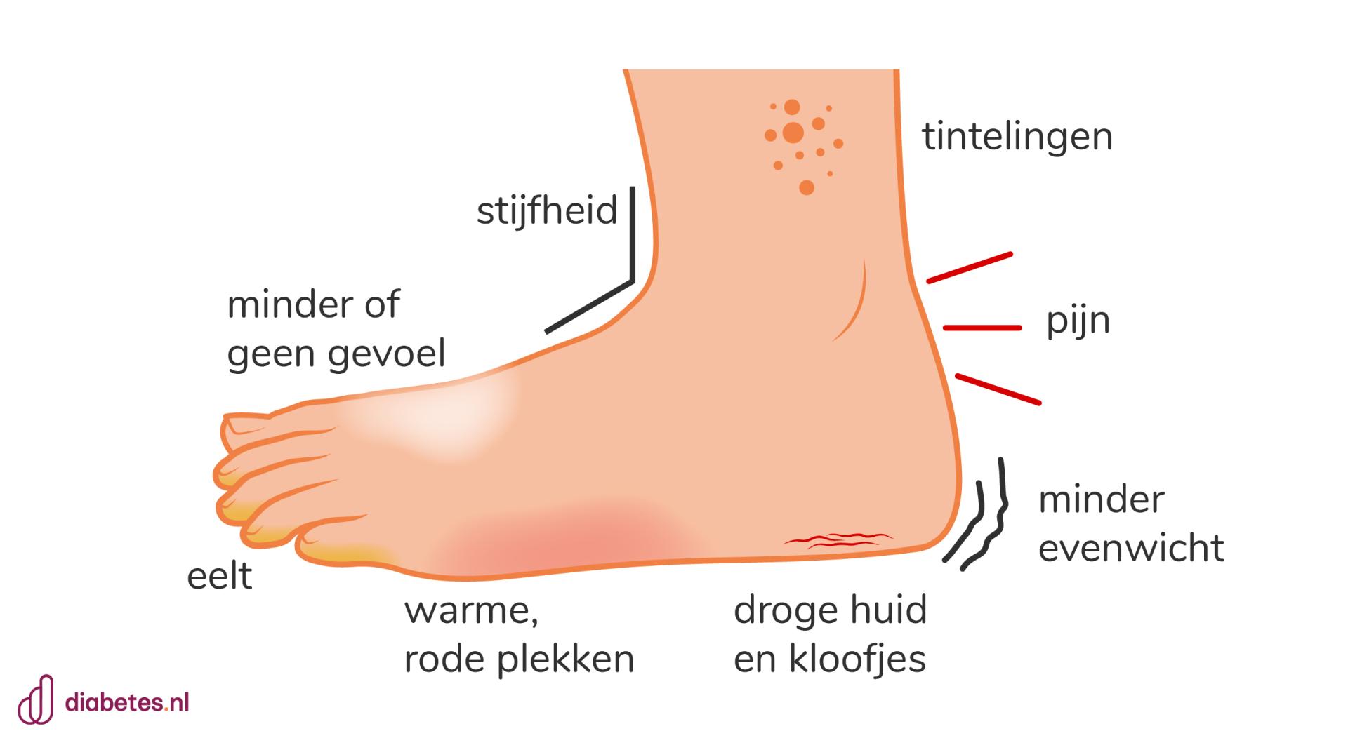 Klachten aan voeten - diabetes.nl